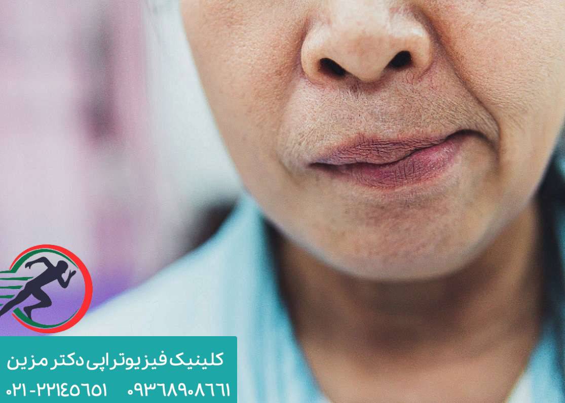نظرات بیماران فلج صورت | مزین فیزیوتراپی